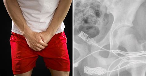 Teen Hospitalized After Getting USB Cable Stuck In His Privates