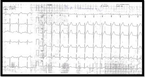 Ecg After 10 H Of Amiodarone Infusion Ecg Shows Conversion To Sinus Download Scientific