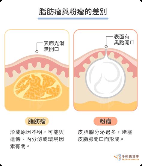 脂肪瘤會自然消失嗎？脂肪瘤原因、切除方法與費用