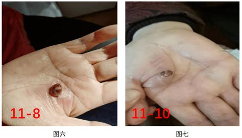 卡瑞利珠单抗导致反应性皮肤毛细血管增生症 ？这样处理效果不错！ 患者 Immune 免疫