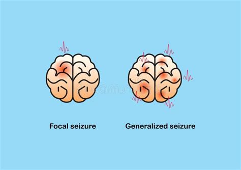 Illustration Of Seizure Types Demonstrating By Onset And Brain Waves Stock Illustration
