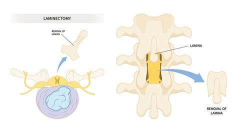 Laminectomy And Discectomy Spinecare Singapore