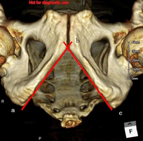 Figure 1 From Sex Determination Based On Measurements Of The Subpubic And Greater Sciatic Notch