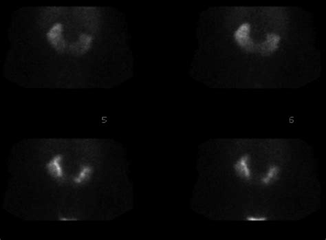 Nuclear Medicine Renogram Showing No Flow To Upper Pole Moiety