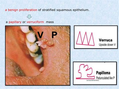 Ppt Squamous Papilloma Clinical And Histopathologic Features