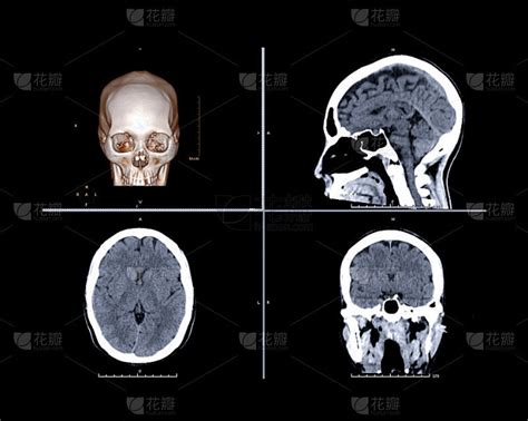 Ct颅脑创伤对比三维渲染图像，矢状面，轴向面和冠状面筛查颅骨骨折。