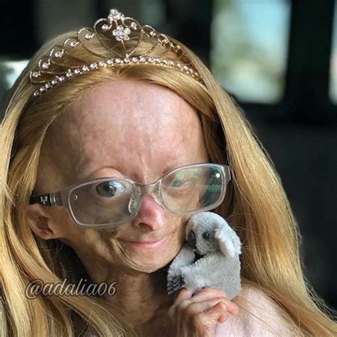 Adalia Rose La Peque A Youtuber Con Envejecimiento Prematuro Que Conquist A Millones De
