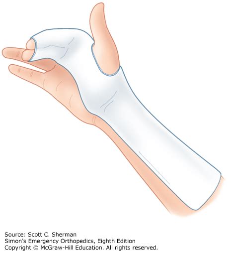 Ulnar Gutter Splint Cast