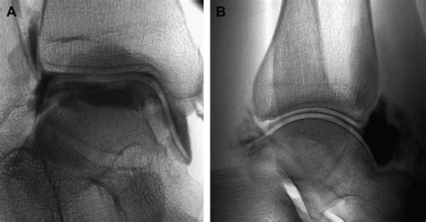 History Of Arthrography Radiologic Clinics History Of Arthrography Radiologic Clinics