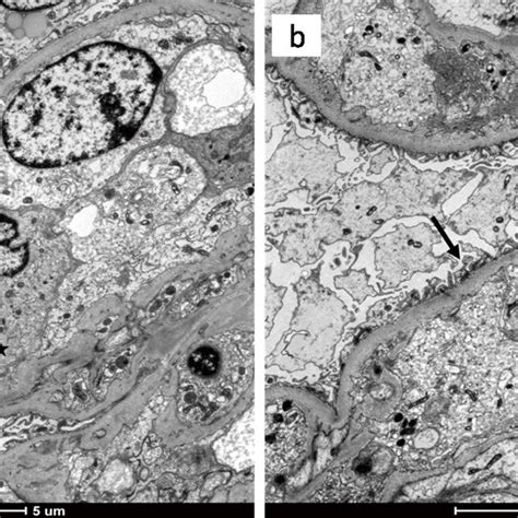 Electron Microscopy Of Diffused Foot Process Effacement Indicated By