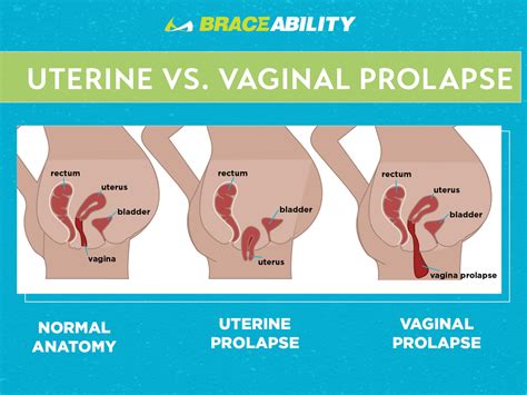 Prolapsed Uterus Stages