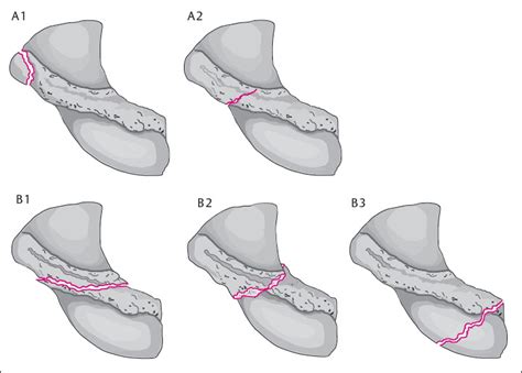 Scaphoid Fracture Classification