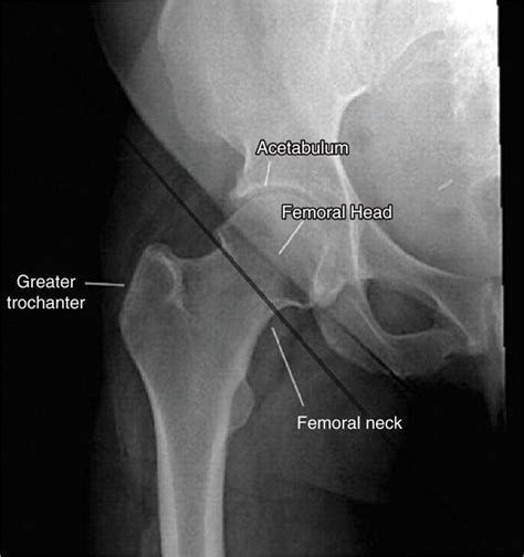 Intra Articular Joint Injections Anesthesia Key