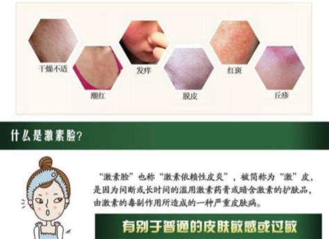 皮肤敏感冷热，情绪激动容易脸红发烫干燥脱皮是不是激素脸？ 知乎