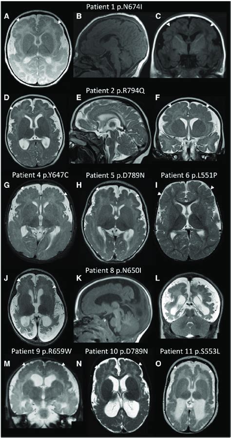 Polymicrogyria In Patients With Grin1 Mutations Axial Midline