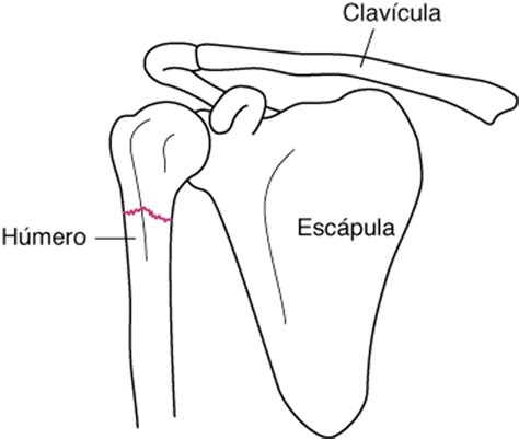 Image Fractura Del Hombro Manuale Merck Versión Para El Público General
