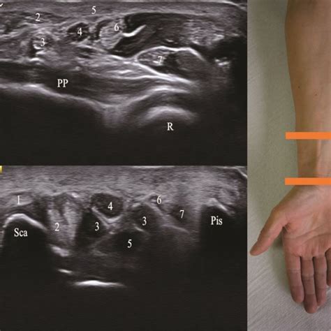 The Median Nerve Ultrasound In The Transverse Plane At Two Different Download Scientific
