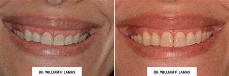 Bonding To Lengthen Teeth At Michael Birdwood Blog