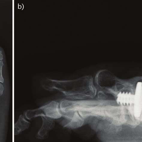 Hattrup And Johnson Radiographic Classification Of Hallux Rigidus
