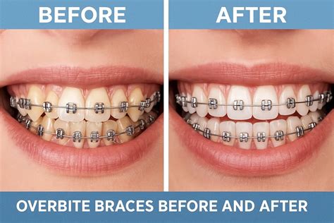 Overbite Braces Before And After What To Expect