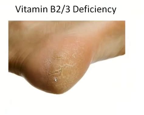 Dry Cracked Heels Is A Vitamin B2b3 Deficiency Vitamins Health