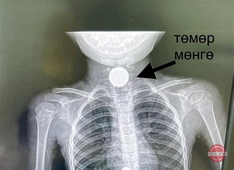 ЭХЭМҮТ ийн эмч нар хүүхдийн улаан хоолойд тээглэсэн зоосыг авчээ