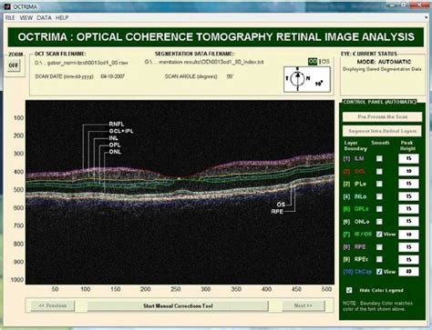 Octrima Screenshot Showing The Segmentation Results For An Oct B Scan Download Scientific