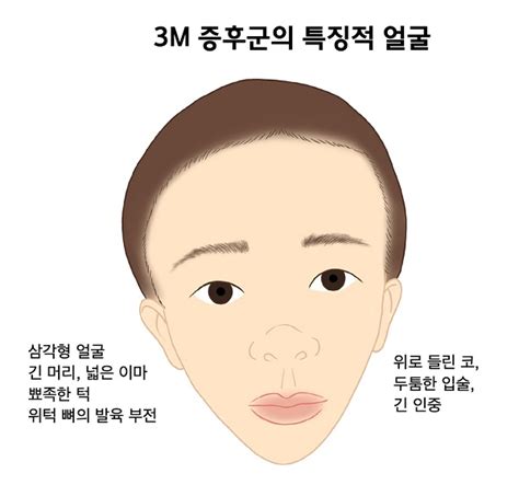 유전질환별 얼굴형 특징