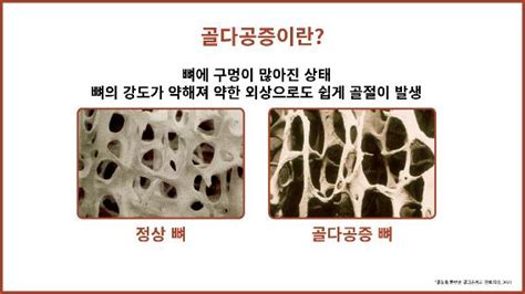 골 흡수가 억제된 상태에서 발치 임플란트 처치를 받으면 회복이 지연돼 괴사