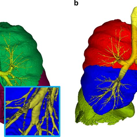 Comparison Of Airway And Lung Volumes Before And 1 Year After