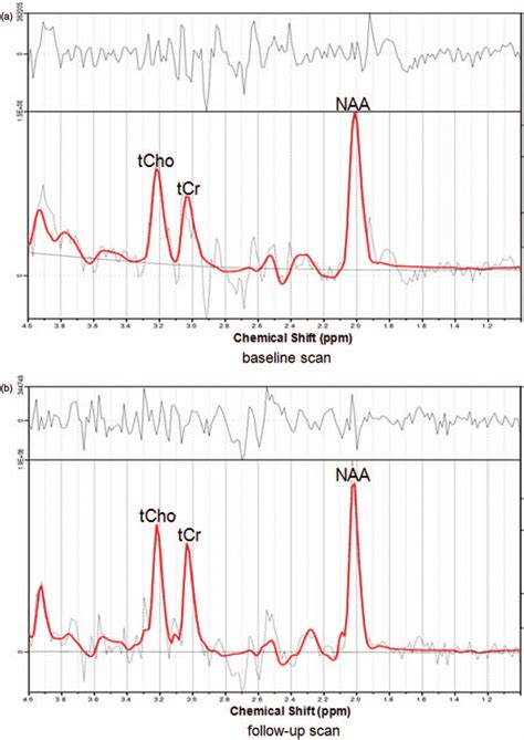 Longitudinal Quantification Of The Pregenual Anterior Cingulate Cortex