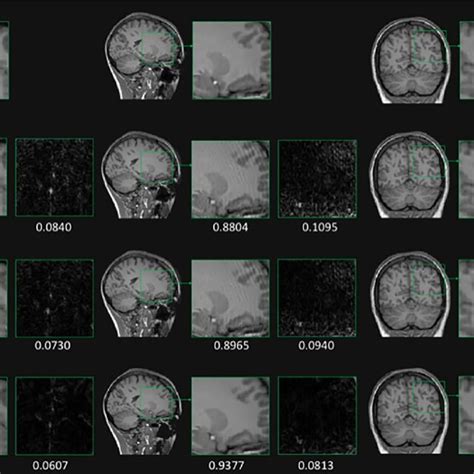Motion Degraded Left Hand Column And Motion Corrected Right Hand Download Scientific Diagram