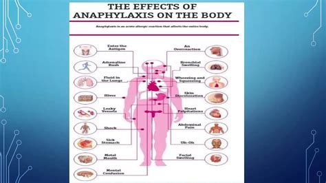 Anaphylaxis Ppt