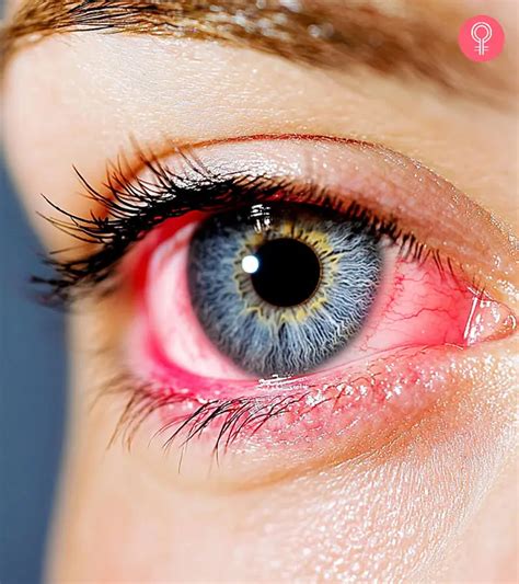 10 Home Remedies To Treat Welders Flash Burn Eyes