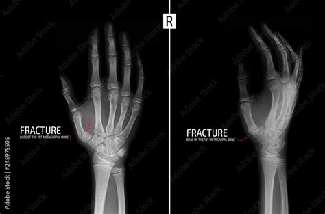1st Metacarpal 1st Metacarpal