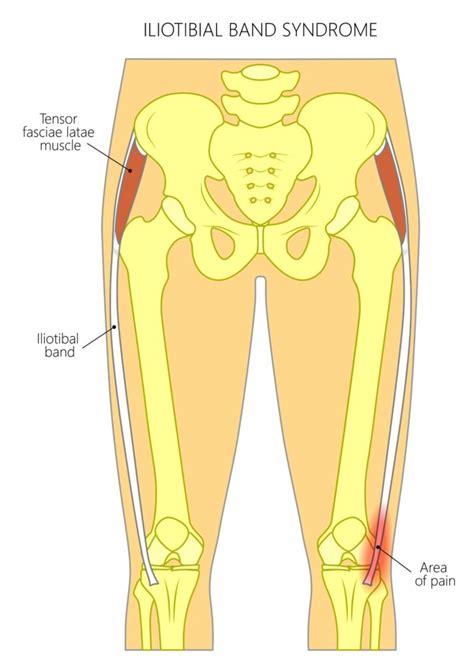 Iliotibial Band Syndrome Complete Physio
