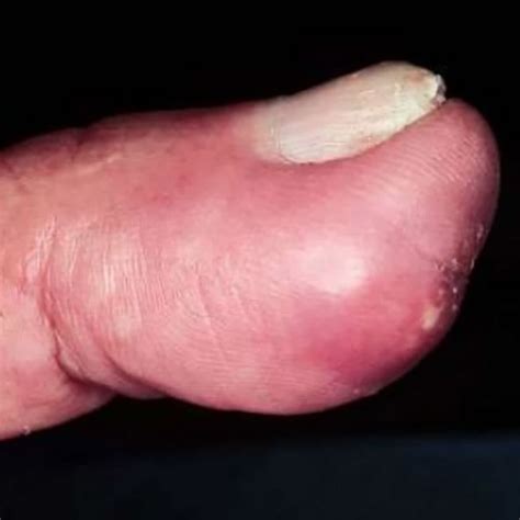 عفونت انگشت نکاتی که باید در مورد عفونت انگشت بدانید مجله پل ایده