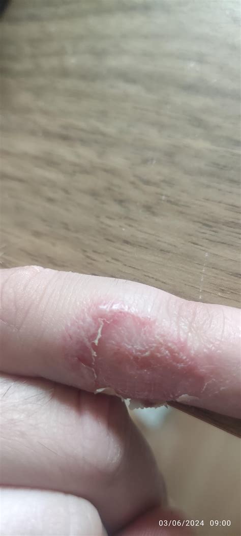 How To Fix This Rash Which Keeps Blistering And Spreading R Dermatologyquestions
