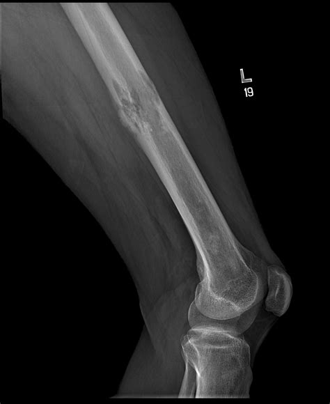 Osteosarcoma Sunburst Appearance