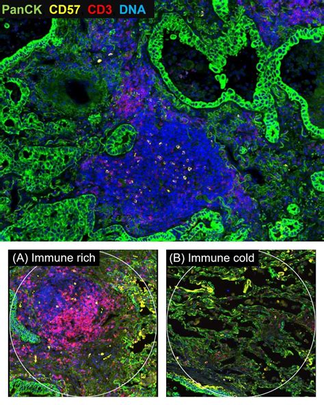 Nanostring Technologies Inc On Linkedin Lungcancer Biotech Science Cancerresearch