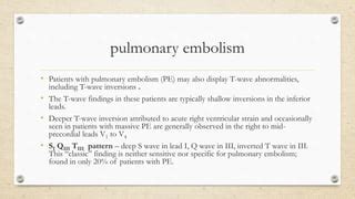 ECG T Wave Inversion Dr Malala Rajapaksha Cardiology Unit General Hospital Matara Sri Lanka