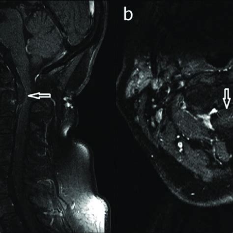 Postcontrast Fat Saturated T1 Weighted Mri Showing A Hypointense Signal Download Scientific