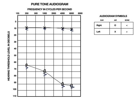 Noise Induced Audiogram Typical Audiogram Showing A Noise Induced