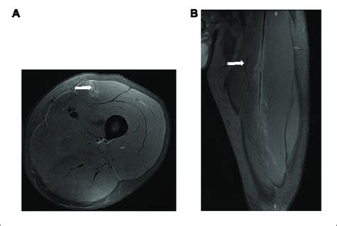 Proximal Mtj Injury Grade 3 Of Rectus Femoris In Axial A And