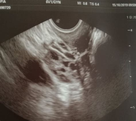 Поликистозни яйчници Тема 5 Проблемно забременяване Страница 6 Мнения от Bg Mamma