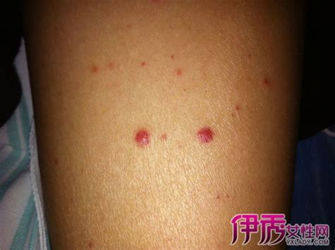 身上有许多小红点 毛细血管破裂 该怎么办