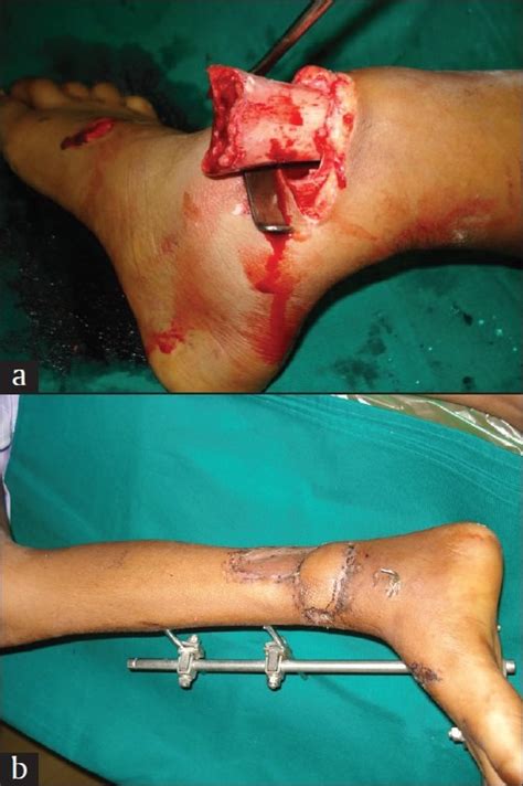 A An Open Fracture Dislocation Of The Ankle Which After Reduction Download Scientific Diagram
