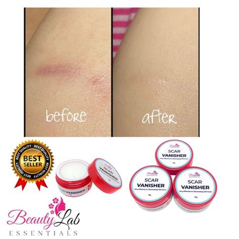 Scar Removal Cream 10g Beauty Essentials Scar Vanisher Scar Cream Scar Repair