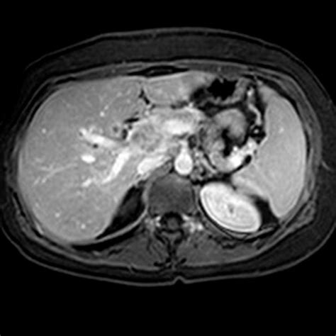 Cholangiocarcinoma Ct