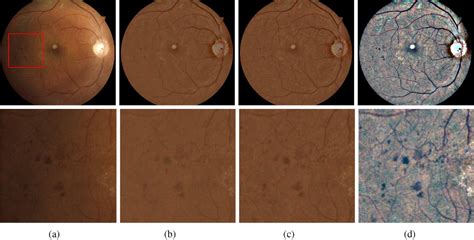 Figure 2 From Red Lesion Detection Using Dynamic Shape Features For Diabetic Retinopathy